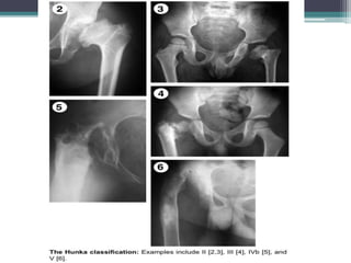 Septic arthritis sequelae. | PPTX