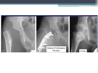 Septic arthritis sequelae. | PPTX