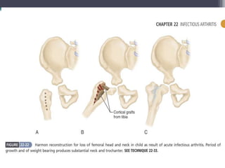Septic arthritis sequelae. | PPTX