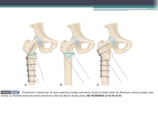 Septic arthritis sequelae. | PPTX