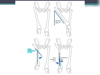 Septic arthritis sequelae. | PPTX