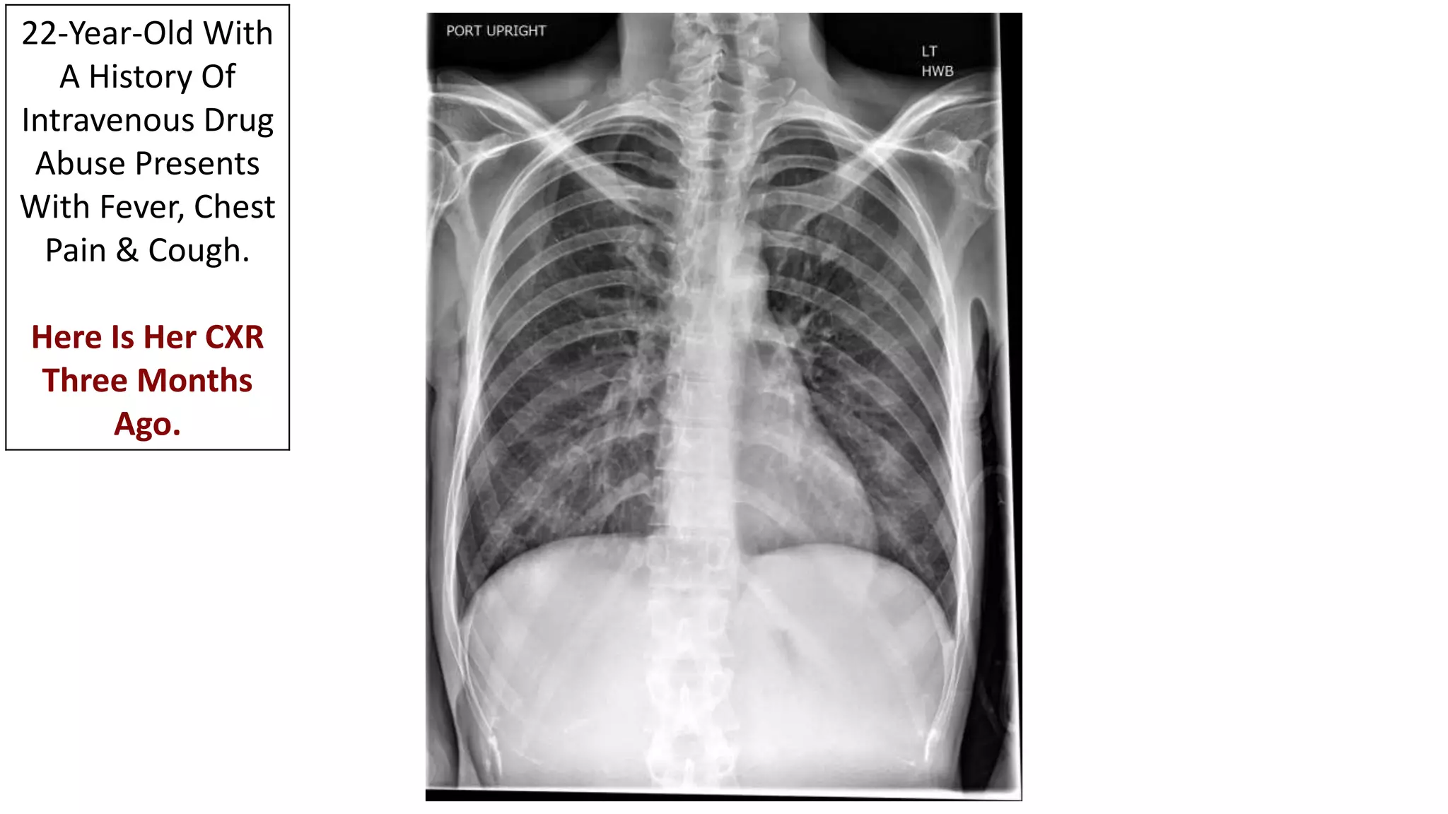 EMGuideWire's Radiology Reading Room: Septic Pulmonary Emboli | PPTX