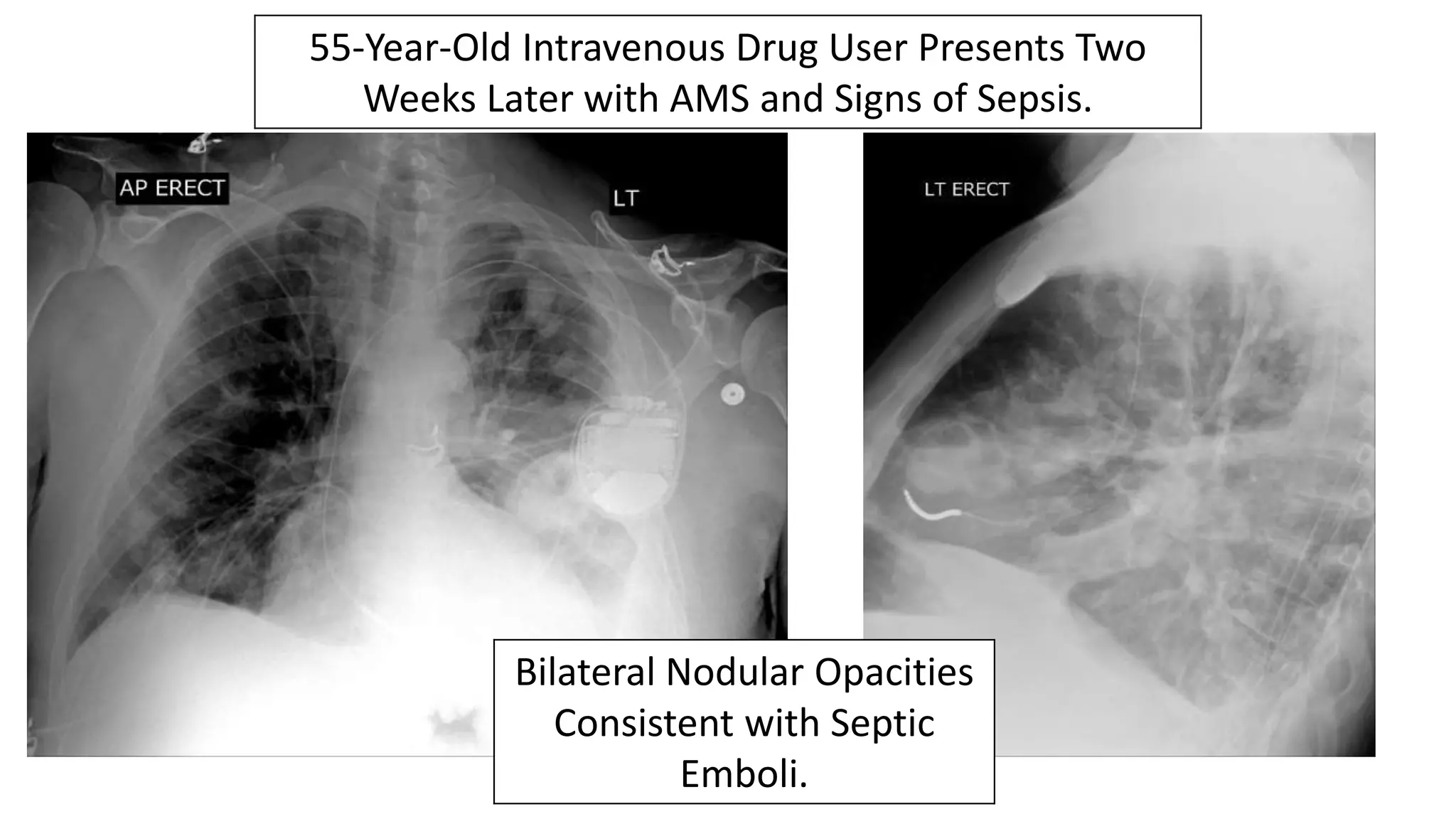 EMGuideWire's Radiology Reading Room: Septic Pulmonary Emboli | PPTX