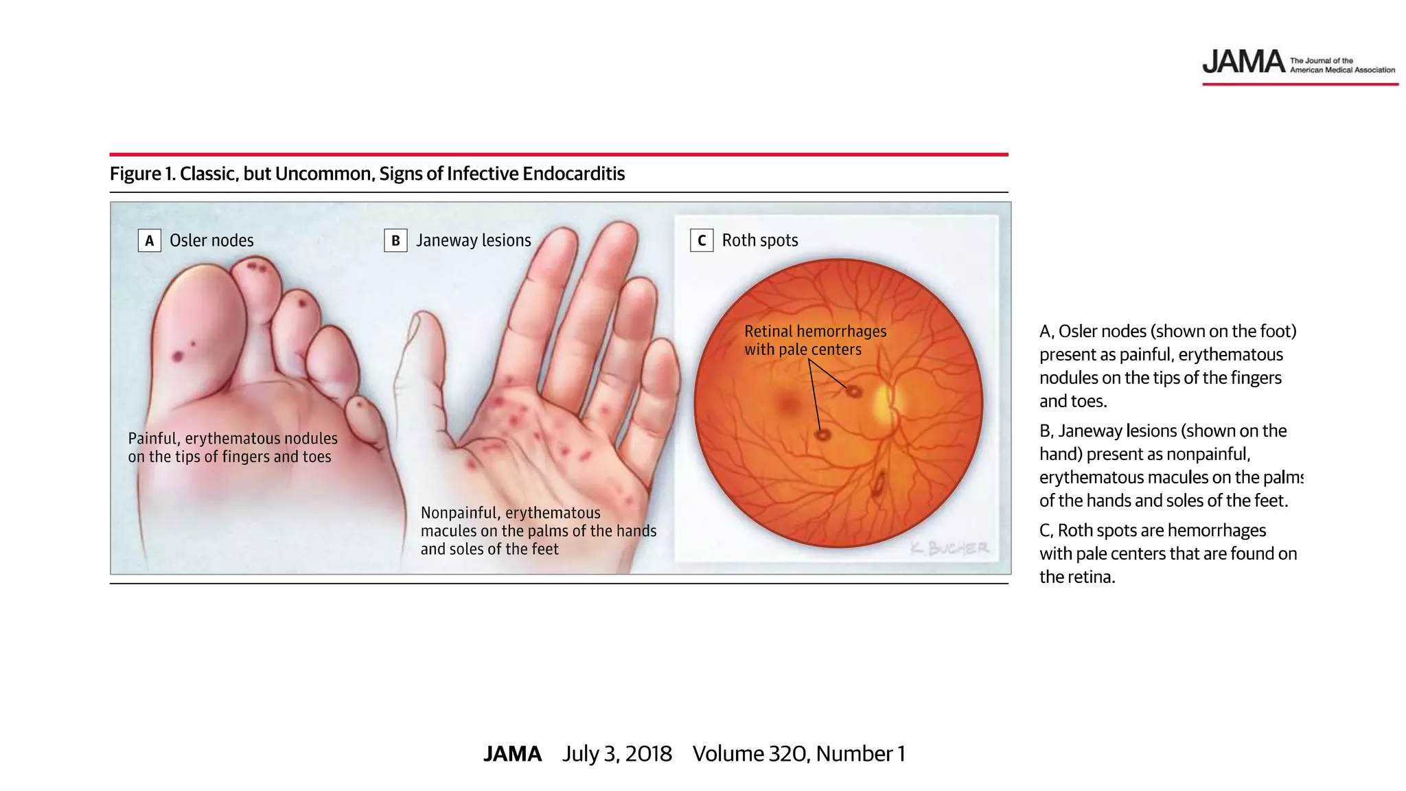 EMGuideWire's Radiology Reading Room: Septic Pulmonary Emboli | PPTX
