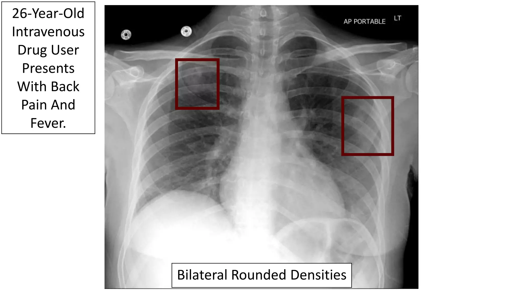 EMGuideWire's Radiology Reading Room: Septic Pulmonary Emboli | PPTX
