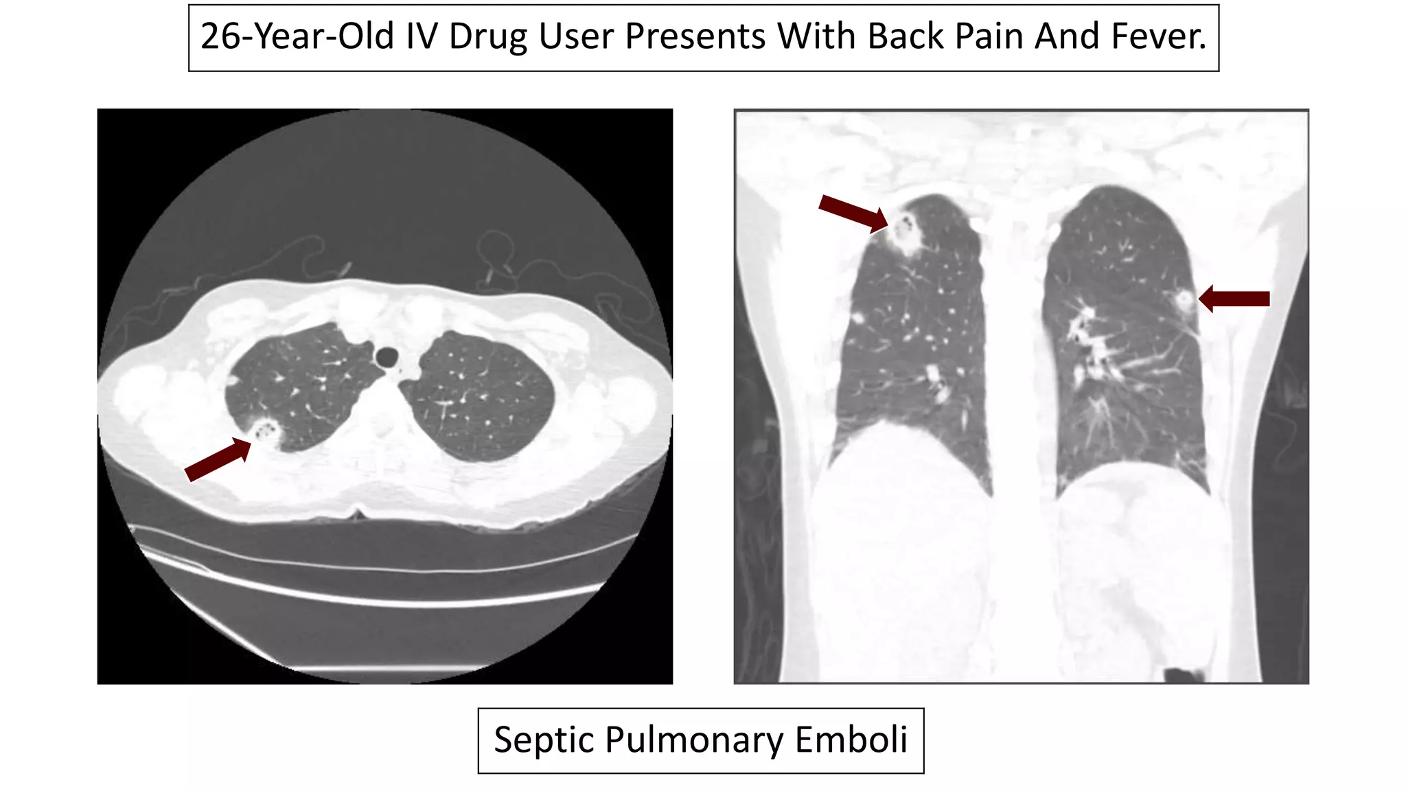 EMGuideWire's Radiology Reading Room: Septic Pulmonary Emboli | PPTX