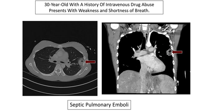 EMGuideWire's Radiology Reading Room: Septic Pulmonary Emboli | PPTX