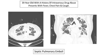 EMGuideWire's Radiology Reading Room: Septic Pulmonary Emboli | PPTX