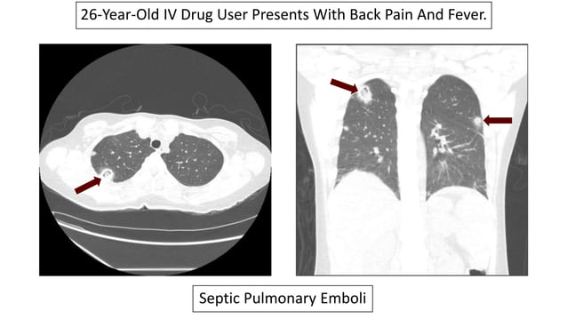 EMGuideWire's Radiology Reading Room: Septic Pulmonary Emboli | PPTX