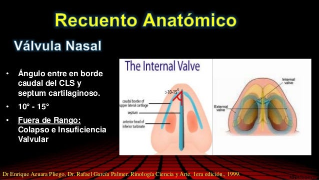 Septoplastia Por Tecnica De Cottle