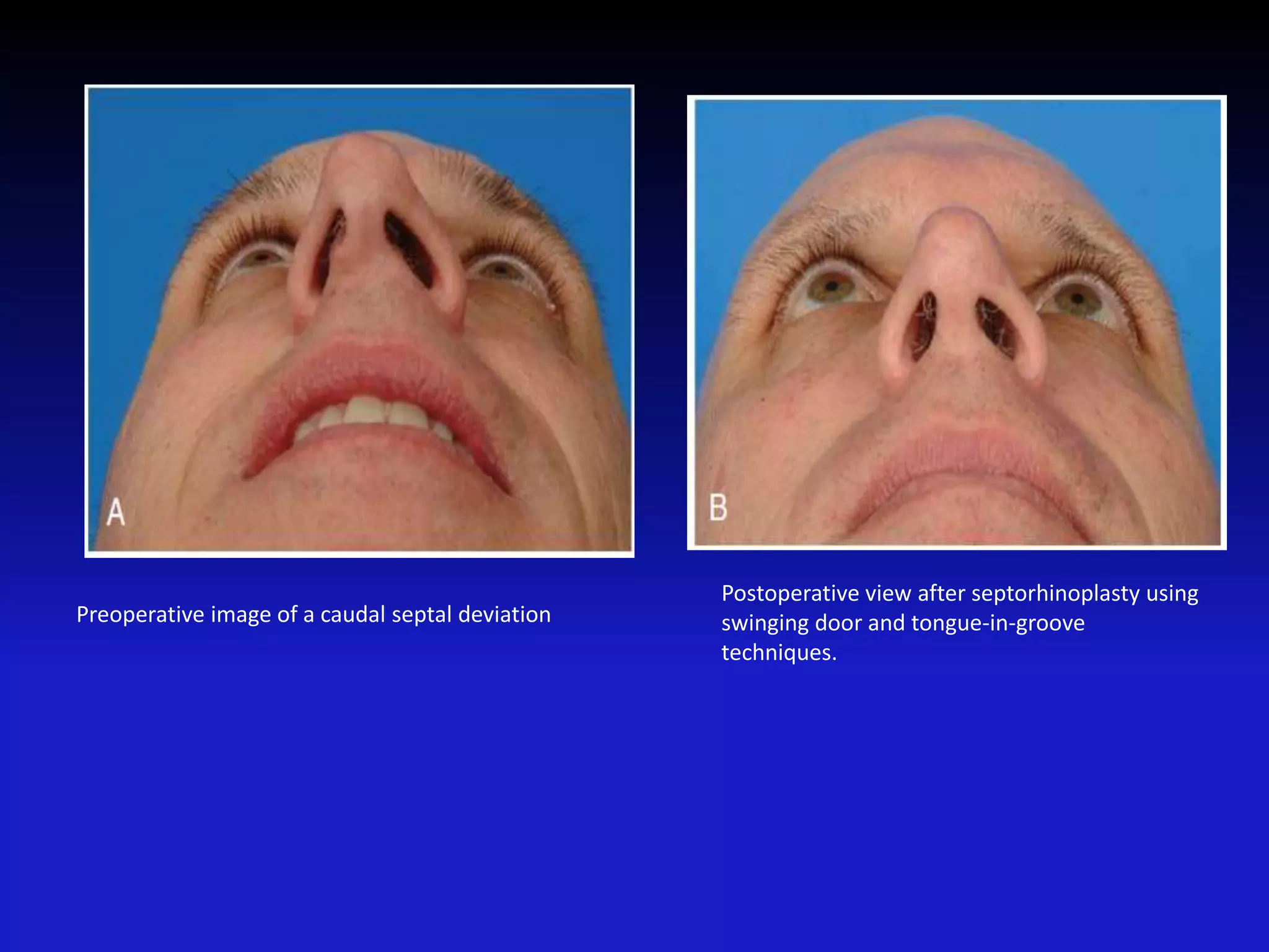 Septoplasty | PPTX