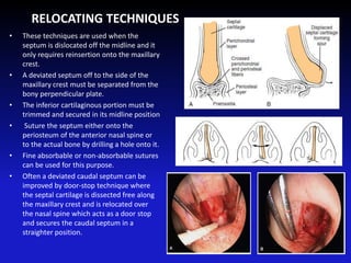 Septoplasty Technique