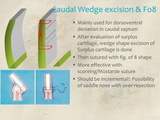 Septoplasty innovative tech | PPTX