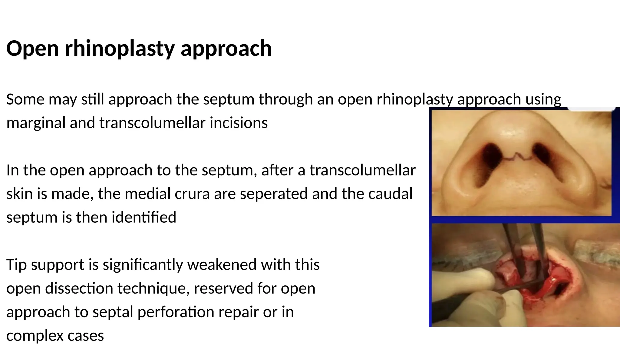 Septoplasty ENT & HEAD NECK SURGERY.pptx