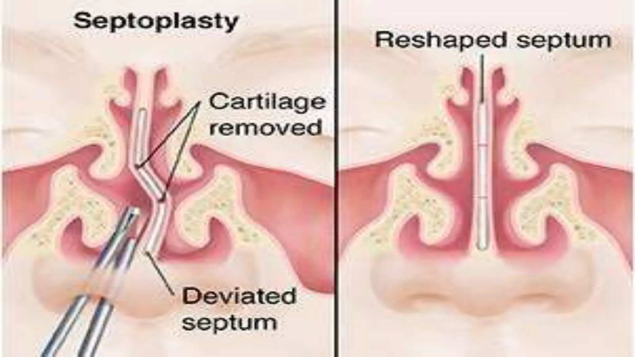 septoplasty procedure _.pptx