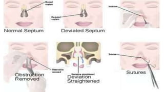 septoplasty procedure _.pptx