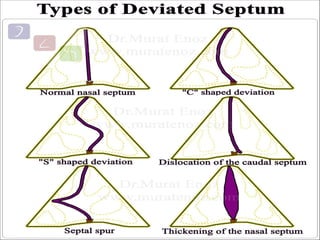 Deviated Nasal Septum Types