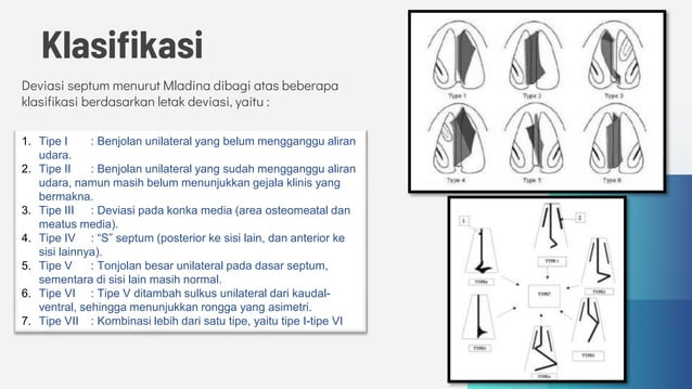 Septum deviasi.pptx