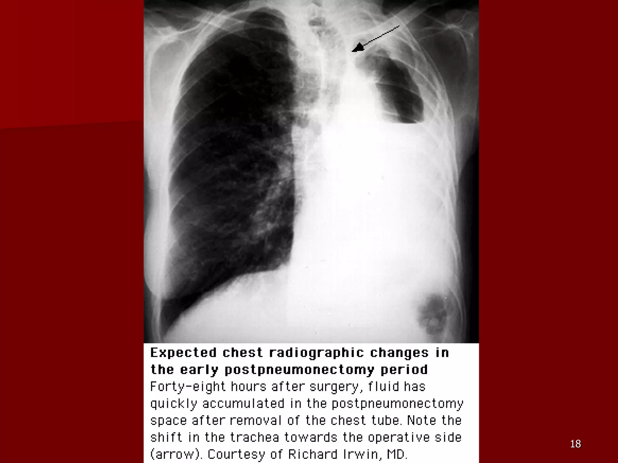 Sequelae & Complications of Pneumonectomy | PPT