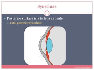 Posterior Synechiae Diagram