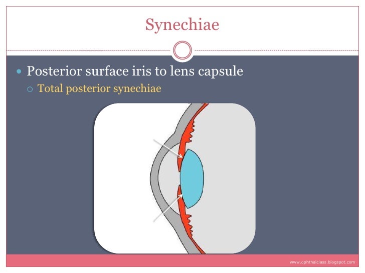 Sequelae & Complications of Uveitis
