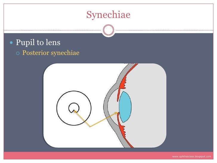Sequelae & Complications of Uveitis