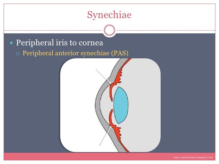 Sequelae & Complications of Uveitis