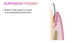 Sequelae of periodontal diseases | PPT