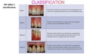 Sequelae of periodontal diseases | PPT