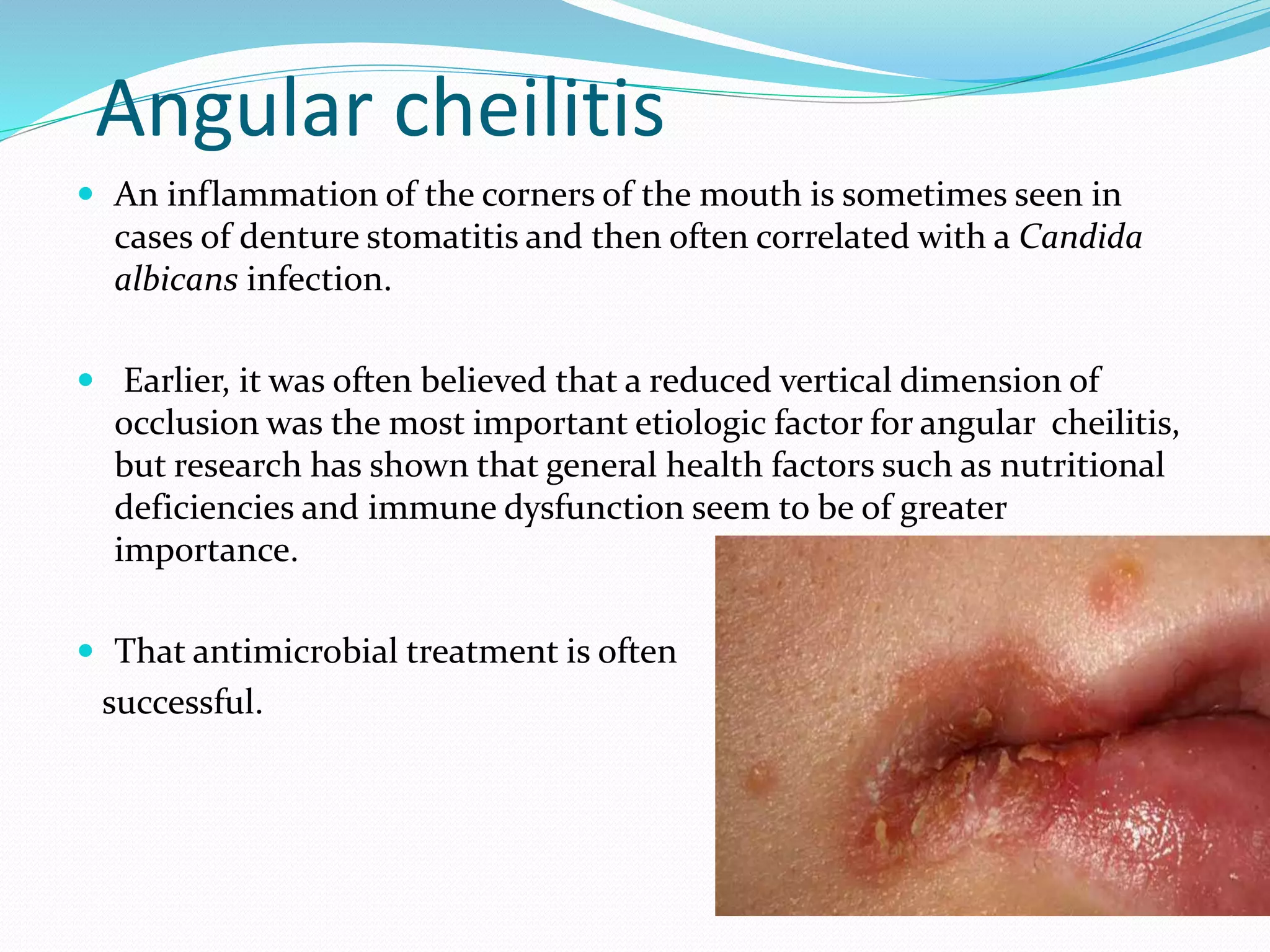 Sequelae of wearing complete denture | PPTX