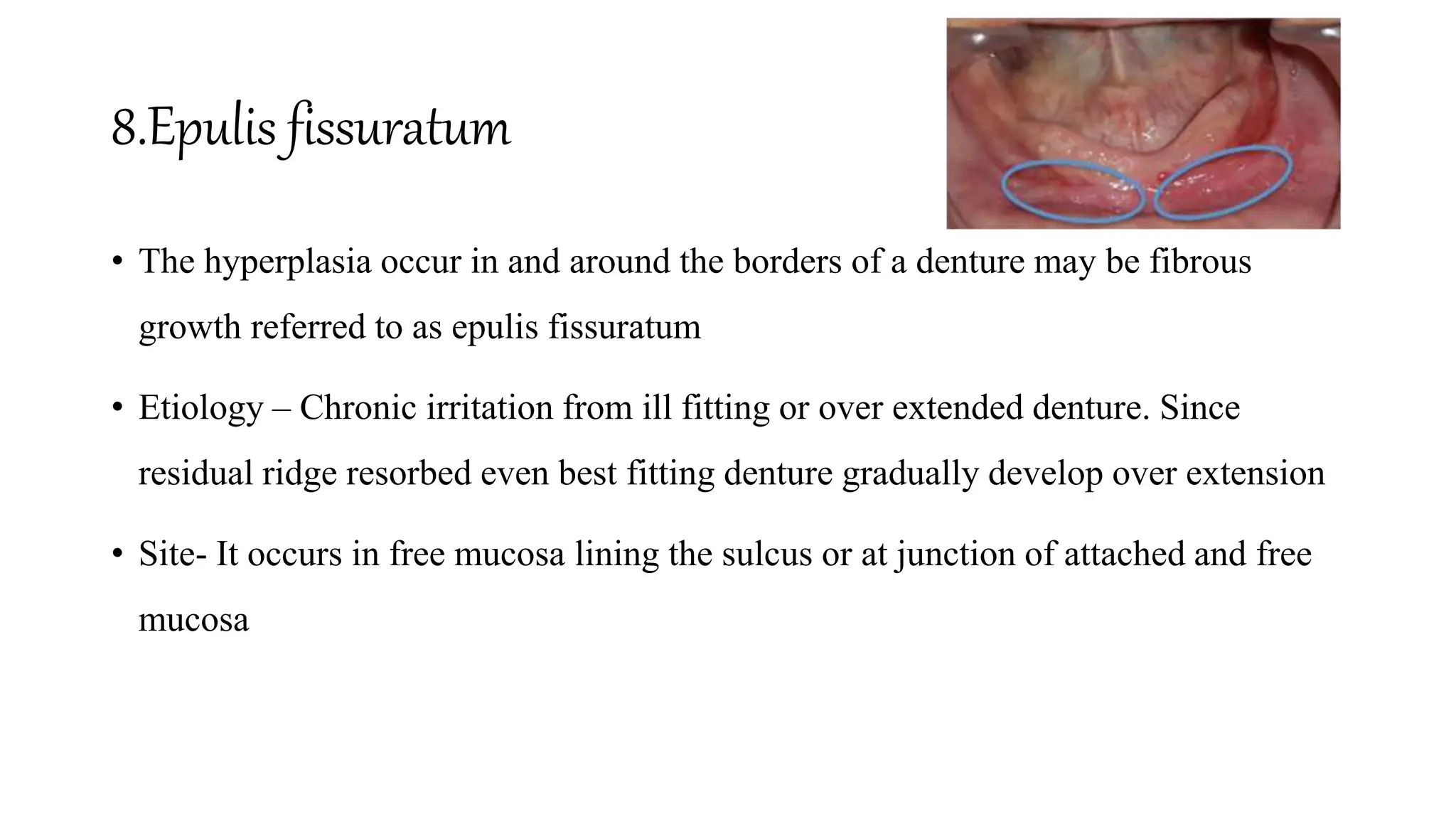 SEQUELAE OF WEARING COMPLETE DENTURE.pptx
