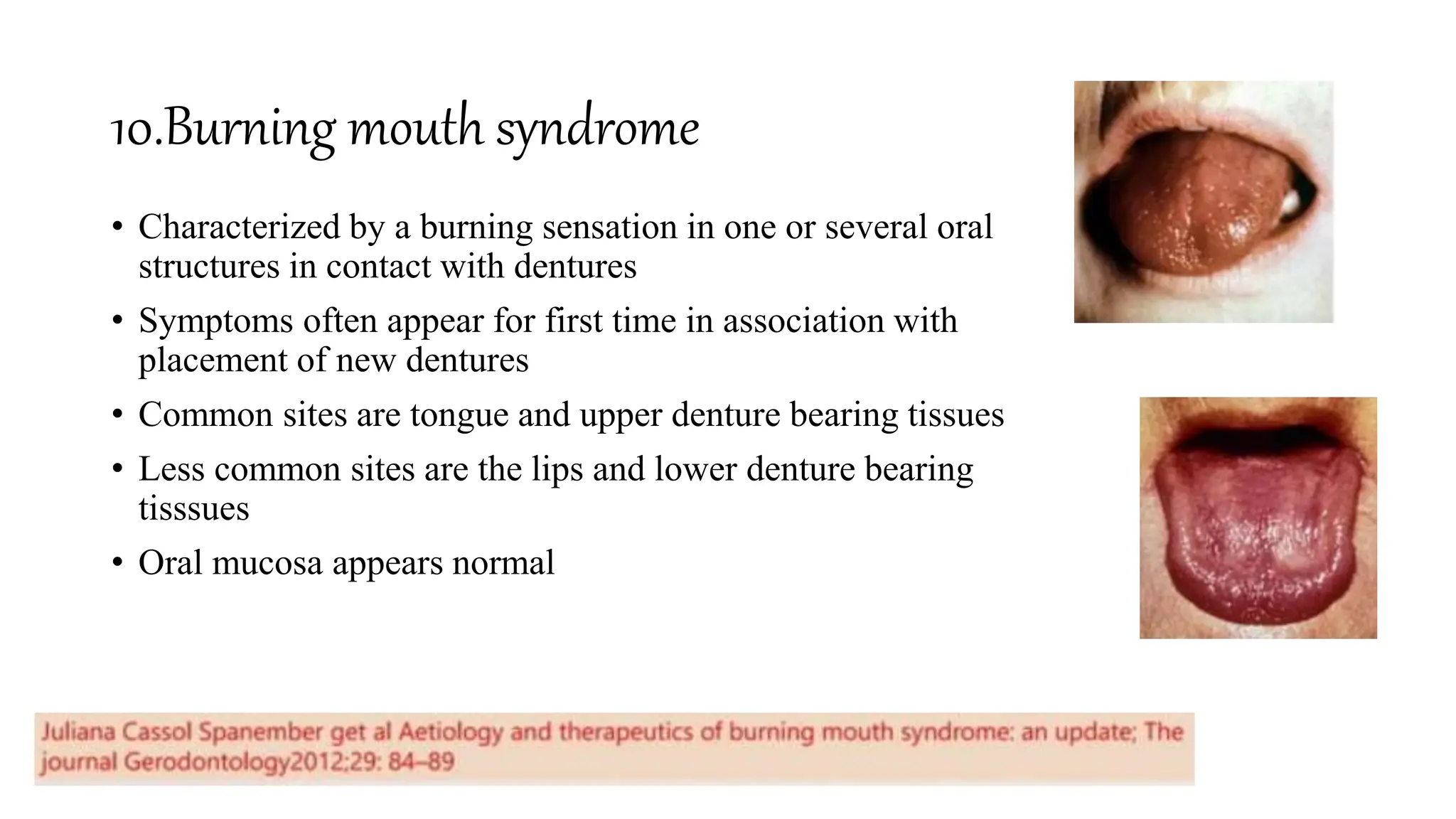 SEQUELAE OF WEARING COMPLETE DENTURE.pptx