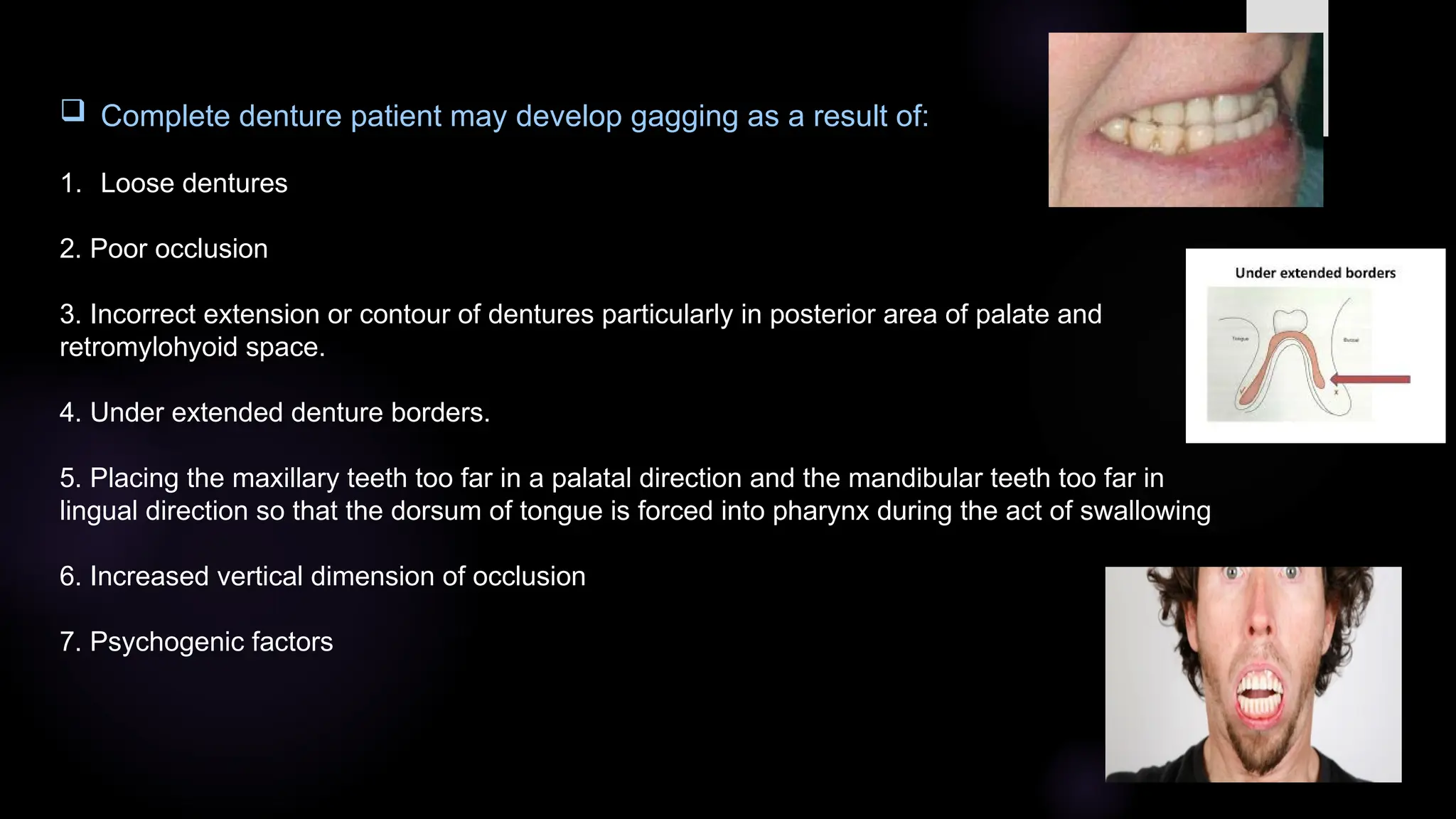 sequelae of wearing complete denture.pptx