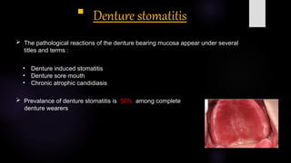 sequelae of wearing complete denture.pptx