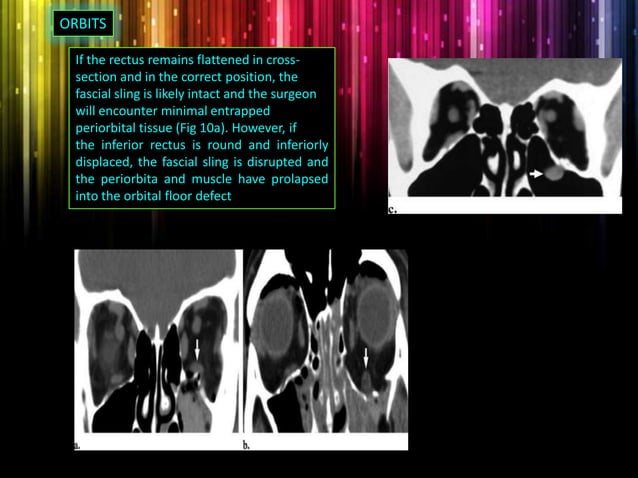 Sequencing in panfacial trauma | PPTX