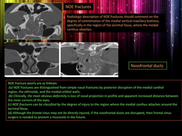 Sequencing in panfacial trauma | PPTX