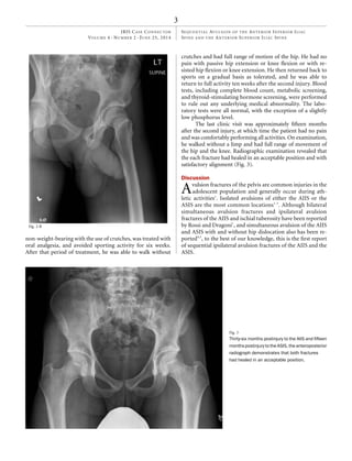 Sequential Ipsilateral Avulsion of the Anterior Inferior Iliac Spine ...