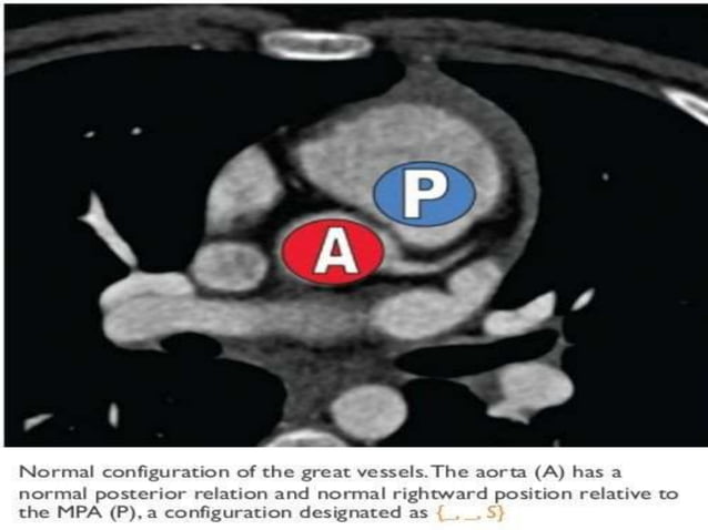 Sequential segmental analysis of heart | PPT