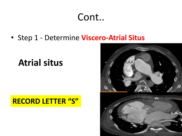 Sequential segmental analysis of heart | PPT