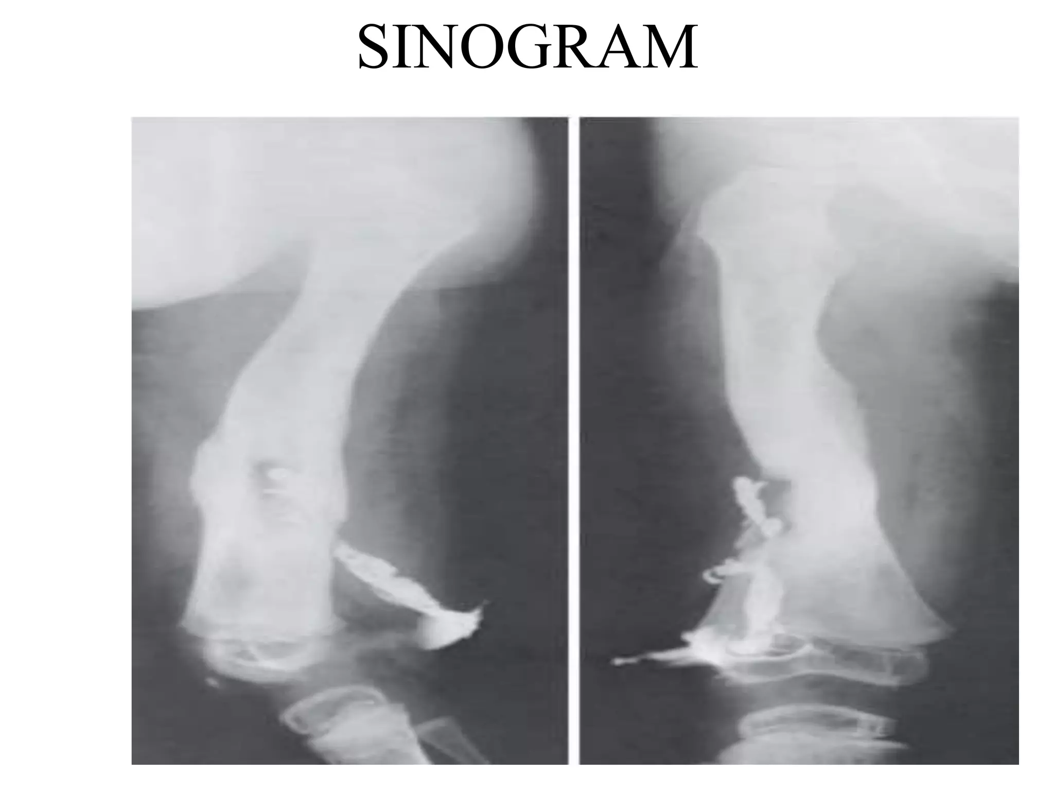 Sequestrum and its types | PPTX