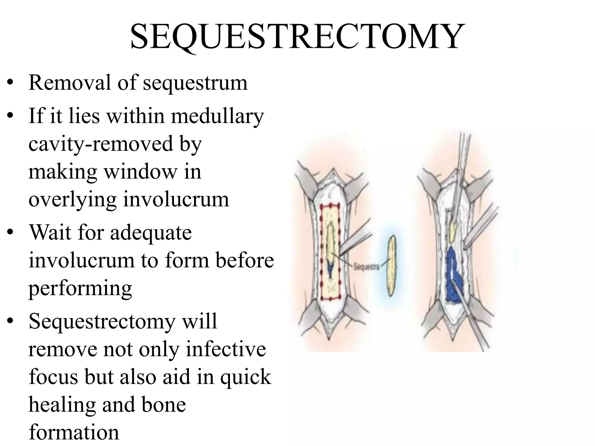 Sequestrum and its types | PPTX