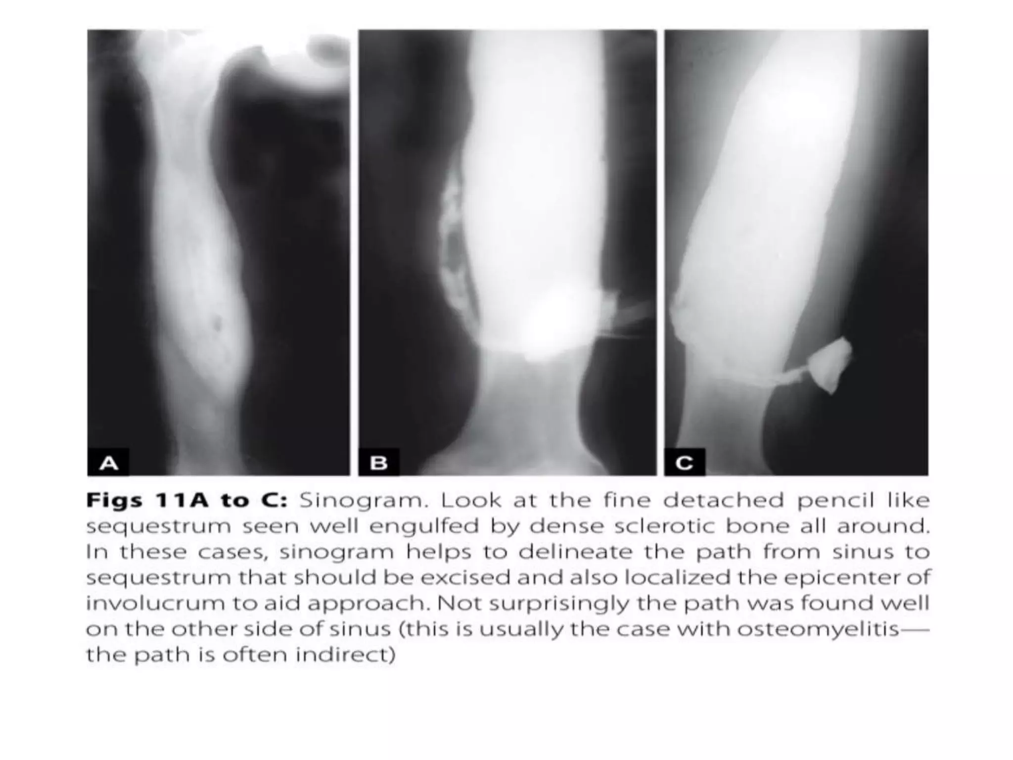 Sequestrum and its types | PPTX