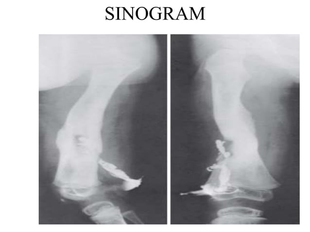 Sequestrum and its types | PPTX