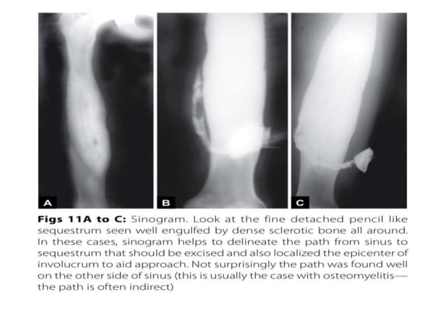 Sequestrum and its types | PPTX