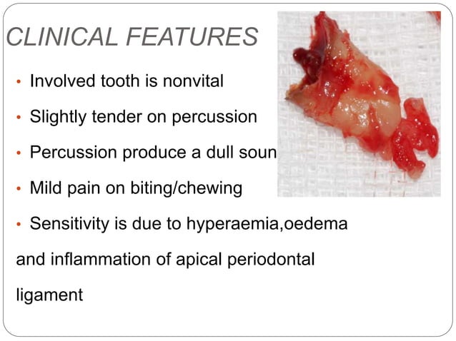 sequle of pulpitis.pptx | Dental Health | Diseases and Conditions