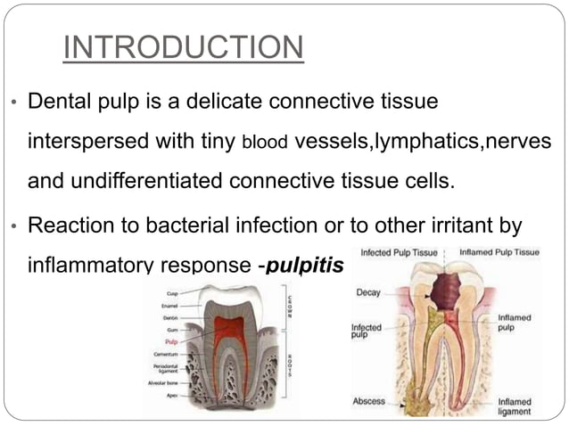 sequle of pulpitis.pptx | Dental Health | Diseases and Conditions