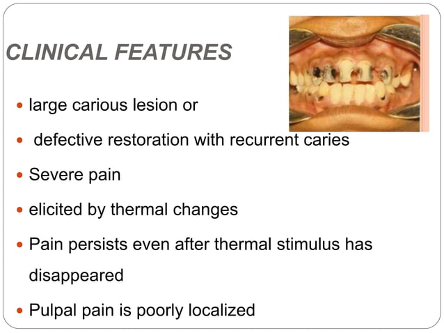 sequle of pulpitis.pptx | Dental Health | Diseases and Conditions