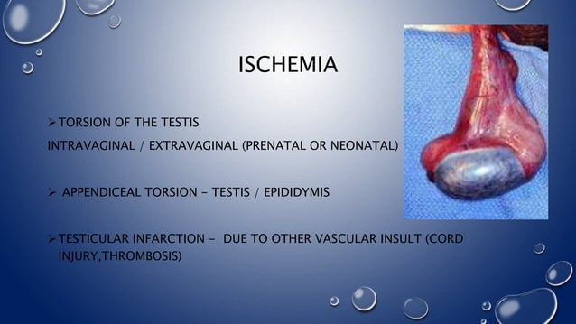 Ser 2016 acute scrotum 1 dr.amitha | PPTX | Reproductive Health ...