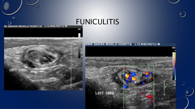 Ser 2016 acute scrotum 1 dr.amitha