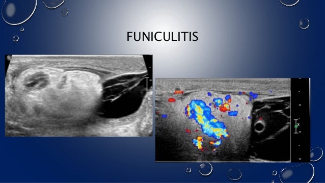 Ser 2016 acute scrotum 1 dr.amitha
